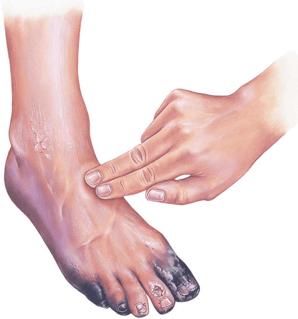 Gangrene Foot - Causes And Prevention | Viasox